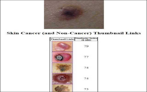 Skin Cancer Image Search